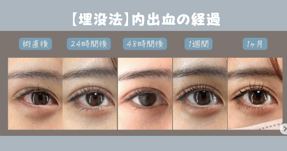 Is the internal bleeding after the buried suture method severe? How ...